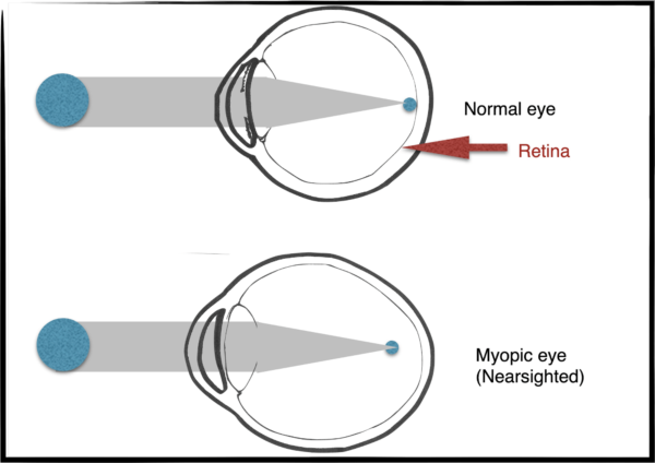 Optometry Terms and Eye Conditions Simply Explained | Eyecare Kids
