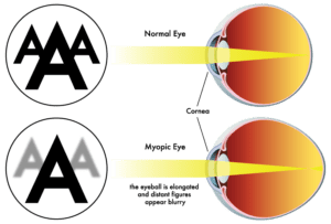 Sydney Experts in Myopia Management | Eyecare Kids